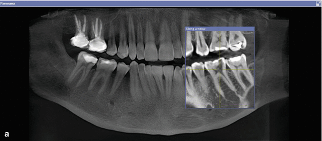 Root Resorption | SpringerLink