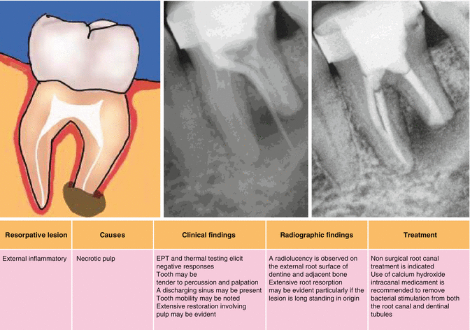 Root Resorption | SpringerLink