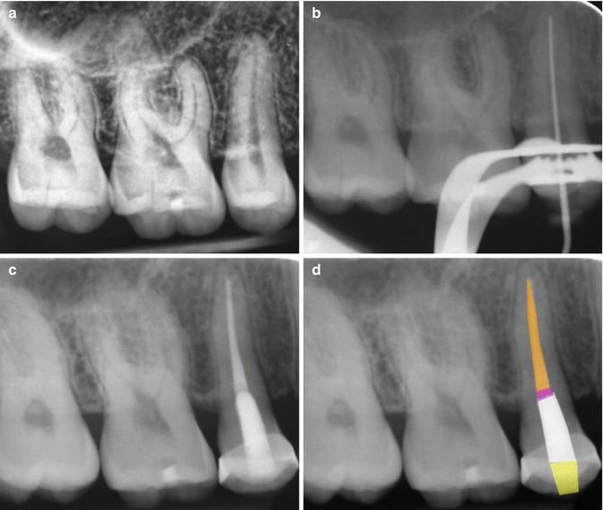 Temporary and Interim Restorations in Endodontics | SpringerLink