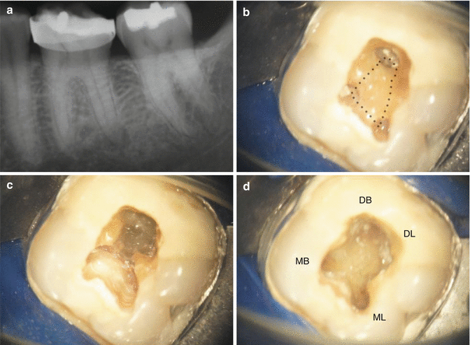 Non-surgical Root Canal Treatment | SpringerLink