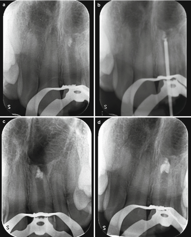 Apexogenesis, Apexification, Revascularization and Endodontic ...