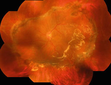 Retinectomy, Retinotomy, and Chorioretinectomy | SpringerLink