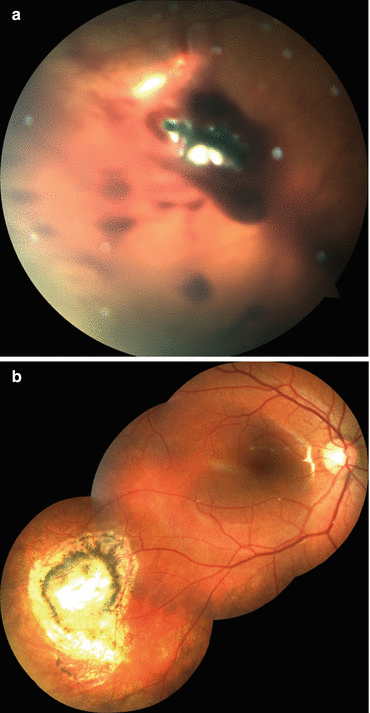 Retinectomy, Retinotomy, and Chorioretinectomy | SpringerLink
