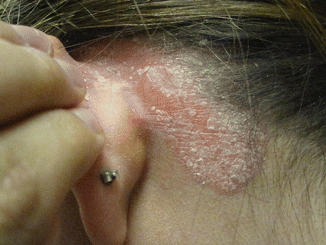 Scalp Psoriasis: Clinical Features and Assessment | SpringerLink