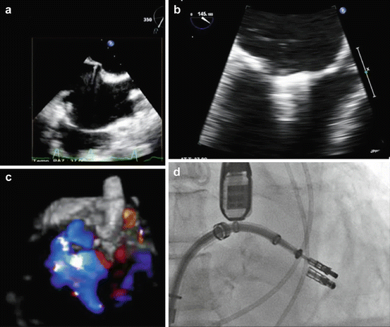 State of the Art of the MitraClip Therapy: Who, When, and How ...