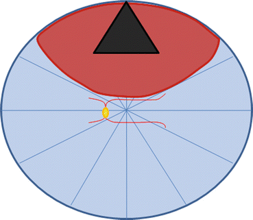 Retinal Detachment | SpringerLink