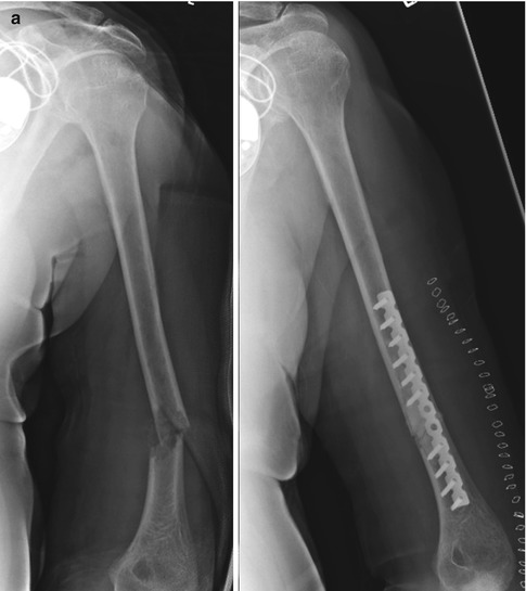 Pathological Fracture of the Humerus | SpringerLink