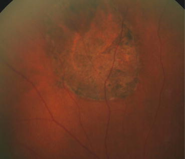 Congenital Hypertrophy of the Retinal Pigment Epithelium | SpringerLink