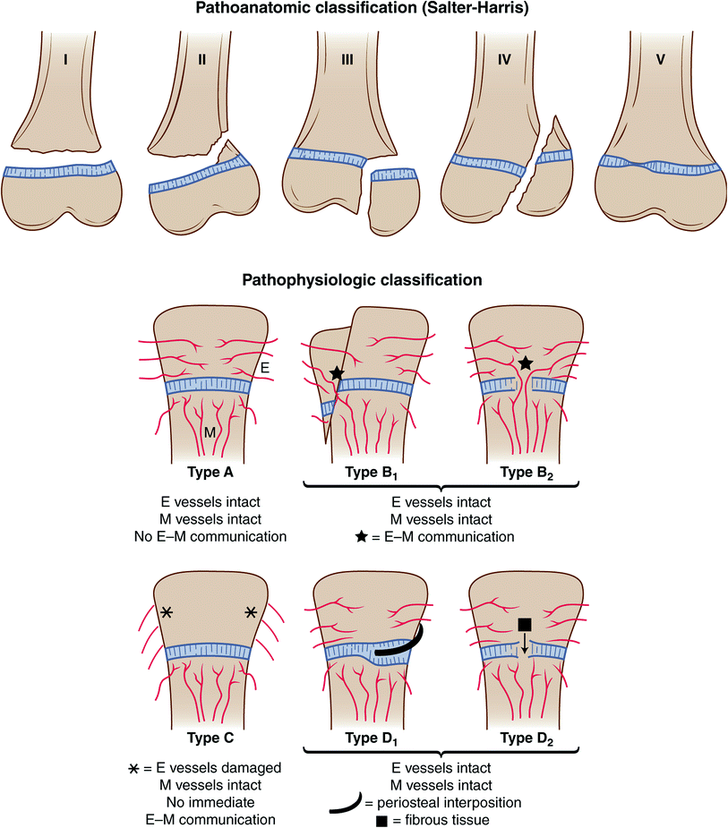 Epiphyseal Growth Plate Fracture-Separations | SpringerLink