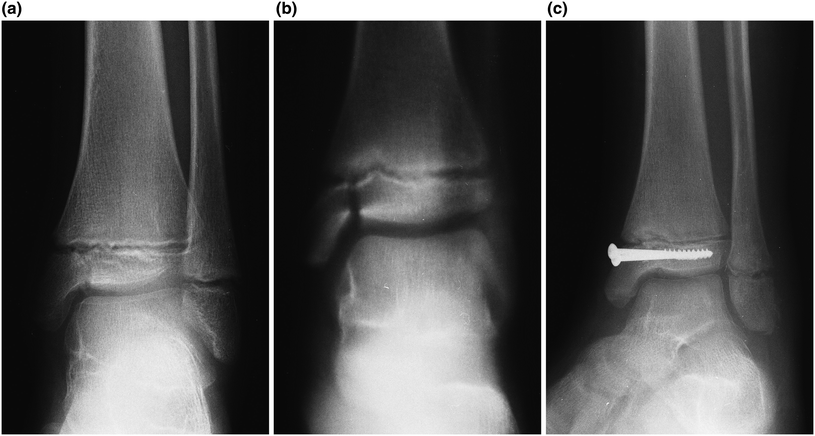 Epiphyseal Growth Plate Fracture-Separations | SpringerLink