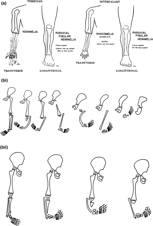 Lower Extremity Length Discrepancies | SpringerLink