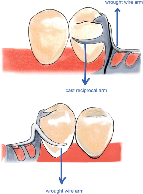 Direct and Indirect Retainers | SpringerLink