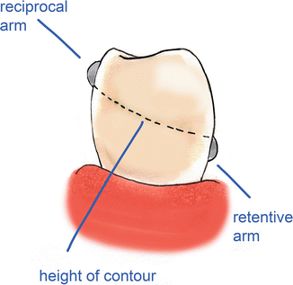 Direct and Indirect Retainers | SpringerLink