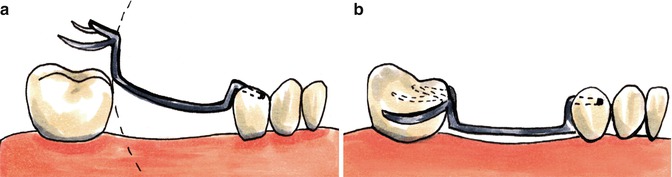Esthetic Solutions for Removable Partial Dentures | SpringerLink