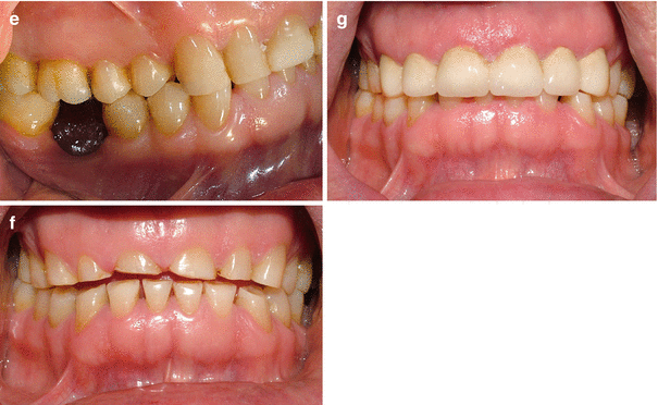Re-establishing Occlusal Vertical Dimension and Maximal Intercuspal ...