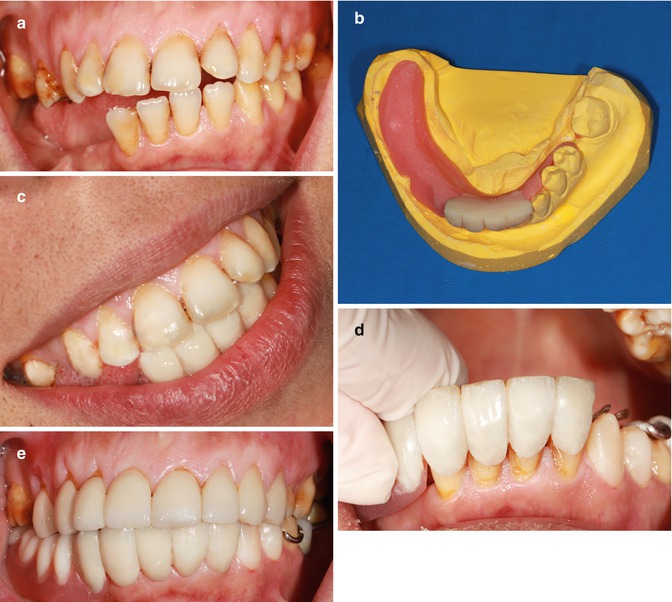 Re-establishing Occlusal Vertical Dimension and Maximal Intercuspal ...