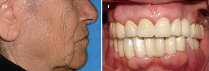 Re-establishing Occlusal Vertical Dimension and Maximal Intercuspal ...