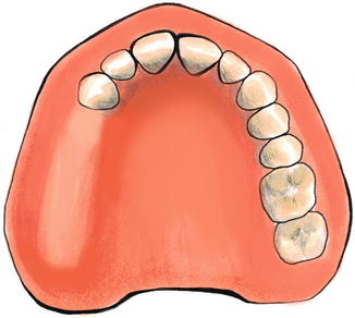 Classification of Partially Edentulous Arches | SpringerLink