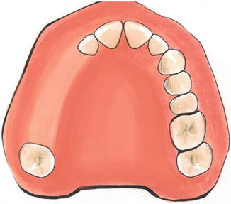 Classification of Partially Edentulous Arches | SpringerLink