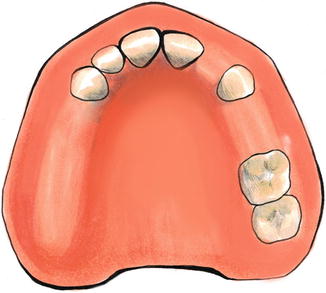 Classification of Partially Edentulous Arches | SpringerLink