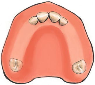 Classification of Partially Edentulous Arches | SpringerLink