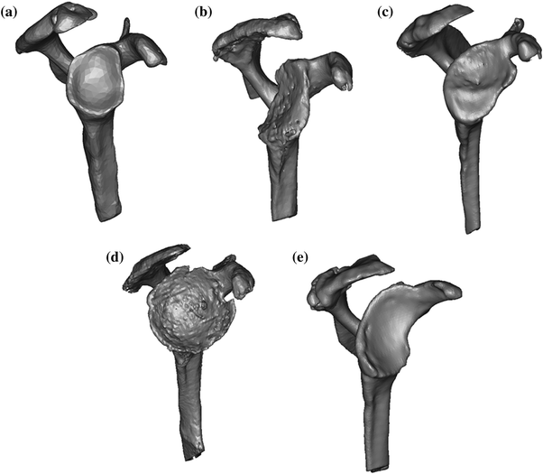 RSA with Glenoid Bone Loss | SpringerLink