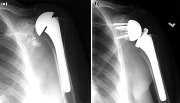 Reverse Prosthesis and the Failed Total Shoulder Arthroplasty ...