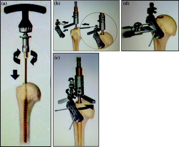 The Biomet Comprehensive© Reverse Total Shoulder System Design ...