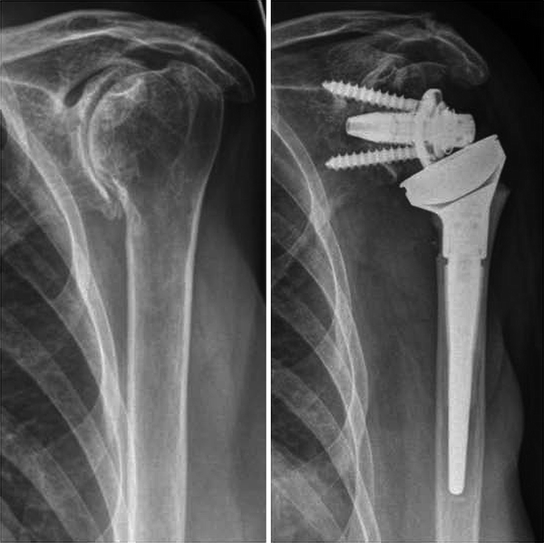 The SMR® Shoulder System of Lima Corporate | SpringerLink