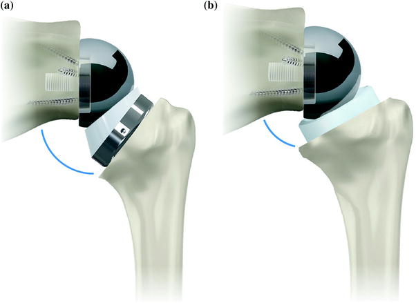 Tornier Aequalis Ascend™ Flex Convertible Shoulder System | SpringerLink