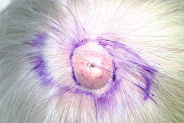 Rotation Flaps of the Scalp: Study of the Design, Planning and ...