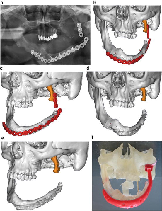 Mandibular Replacement Utilizing TMJ TJR Devices | SpringerLink