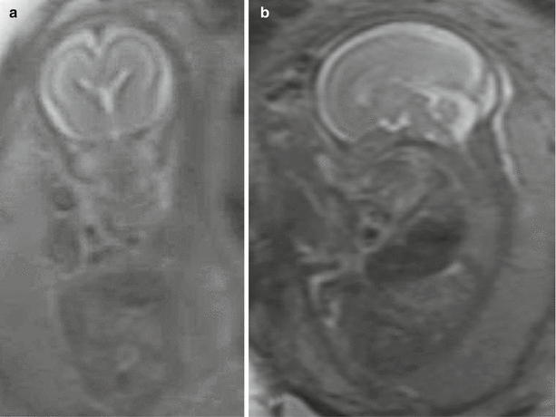Fetal MR Imaging: Protocols and Anatomy | SpringerLink