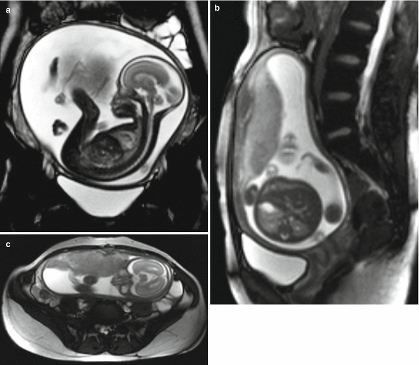 How to Read and to Report a Fetal MRI Examination | SpringerLink