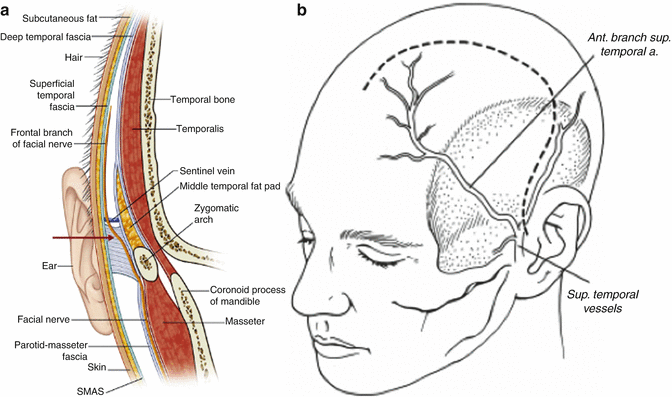 Cranial Base Reconstruction After Transcranial and Transnasal Skull ...