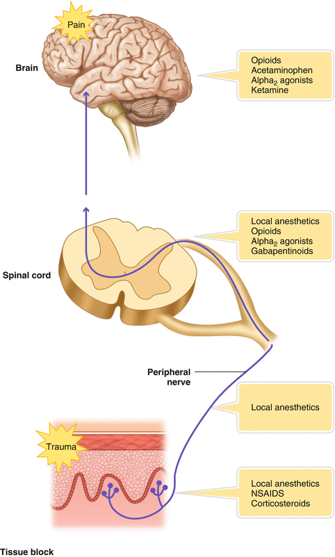 Perioperative Pain Management: Multi-modalities to Prevent ...