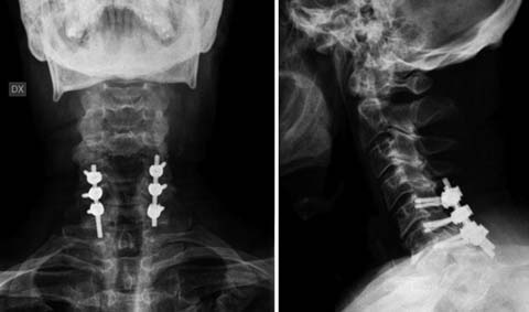 Lateral Mass Screw Fixation of the Subaxial Cervical Spine | SpringerLink