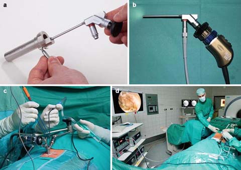 Endoscopy in Cervical Spine Surgery | SpringerLink