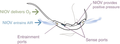 Noninvasive Open Ventilation (NIOV™) Therapy: Clinical Implications ...