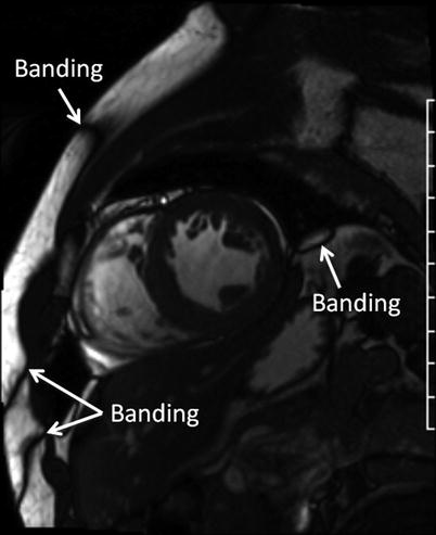 Cardiac Cine Imaging | SpringerLink