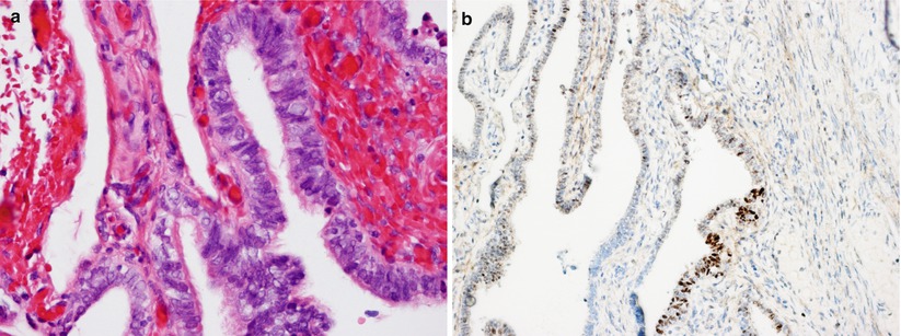 Indications for Salpingectomy | SpringerLink