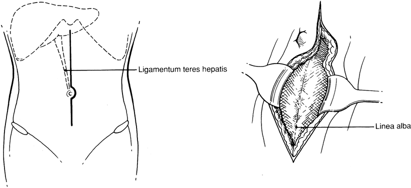 Midline Laparotomy | SpringerLink