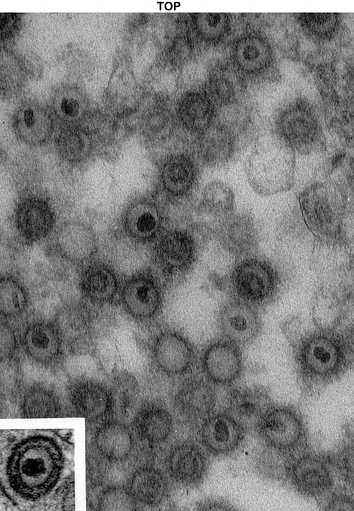 Why and How Epstein-Barr Virus Was Discovered 50 Years Ago | SpringerLink