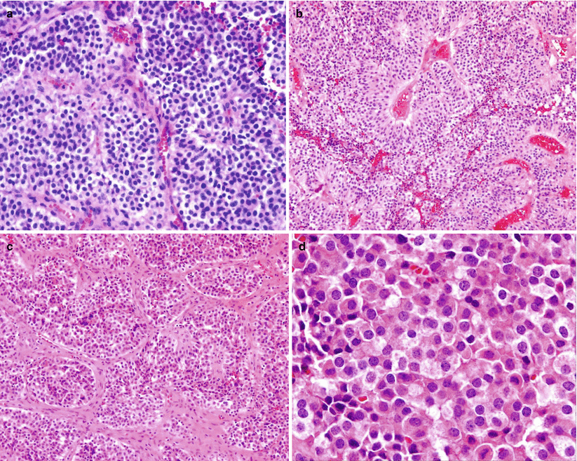 Gonadotroph Adenomas | SpringerLink