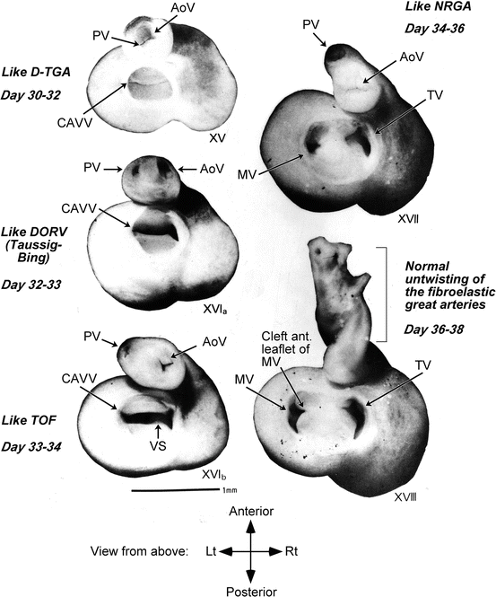Definition of Conotruncal Anomalies | SpringerLink