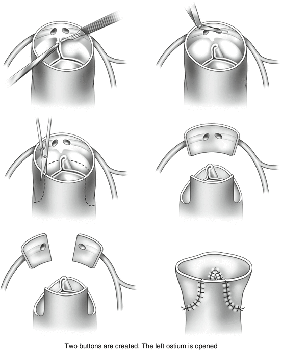 Arterial Switch in TGA-IVS: Coronary Transfer | SpringerLink