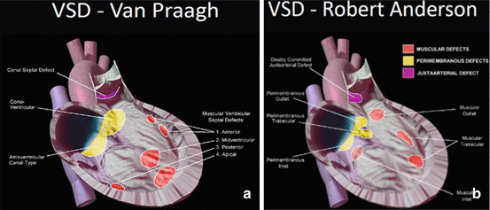 Arterial Switch for TGA or DORV and VSD, with and Without Aortic Arch ...