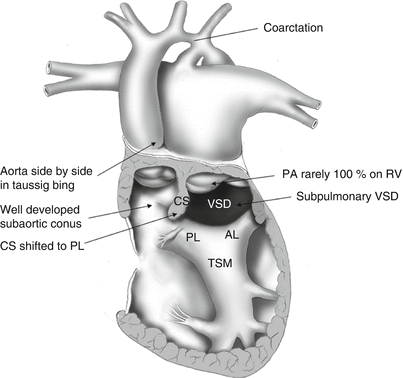 Arterial Switch for TGA or DORV and VSD, with and Without Aortic Arch ...