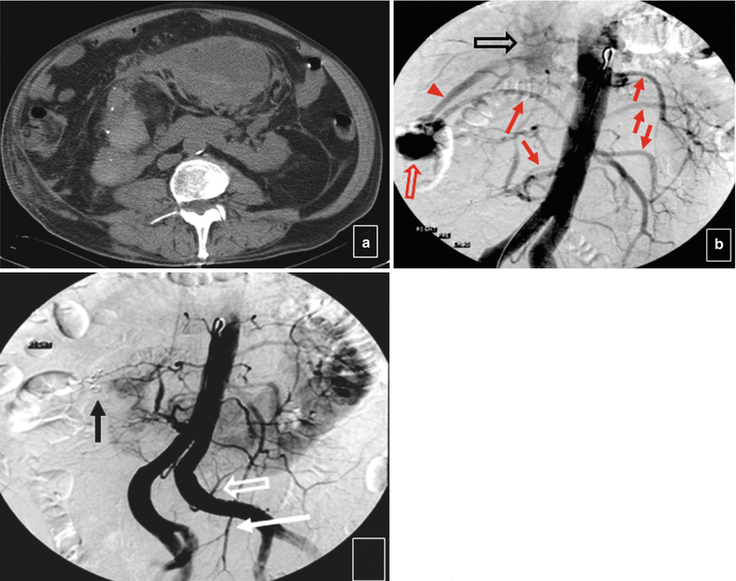 Renal Angiography and Embolization | SpringerLink