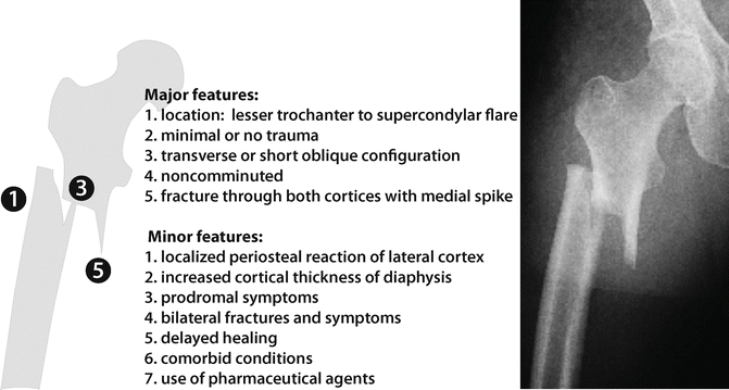 Factors Contributing to Atypical Femoral Fractures | SpringerLink